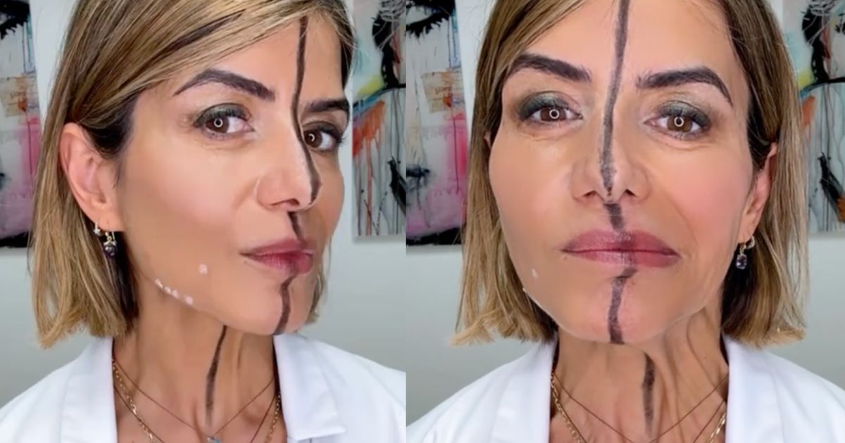 Zdravnica razkriva osupljive učinke botoksa: vbrizgala si ga je le na ...